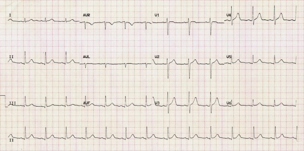 001 normal-sinus-rhythm | Emergency Medicine PNG