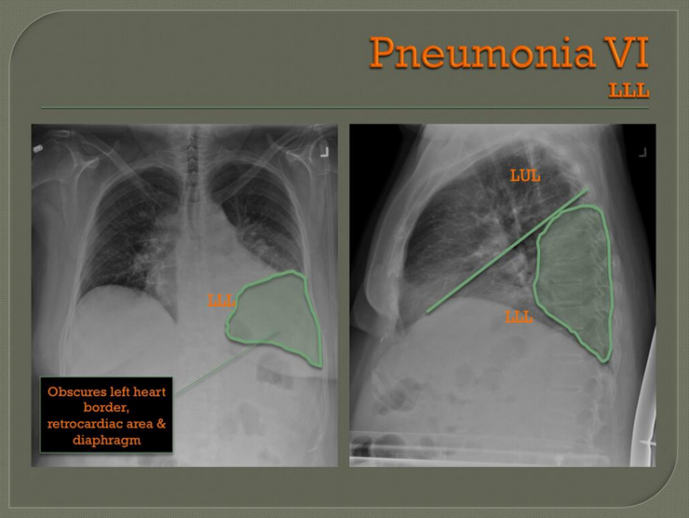 001 LLL Pneumonia diagram | Emergency Medicine PNG