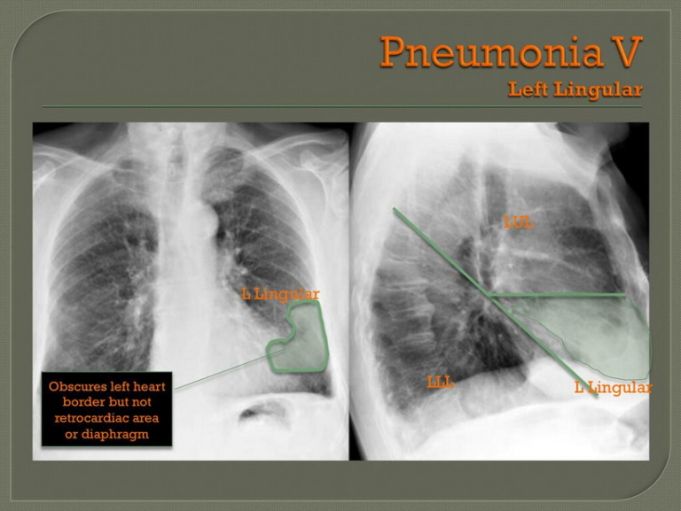 001 LUL Lingular Pneumonia diagnram | Emergency Medicine PNG