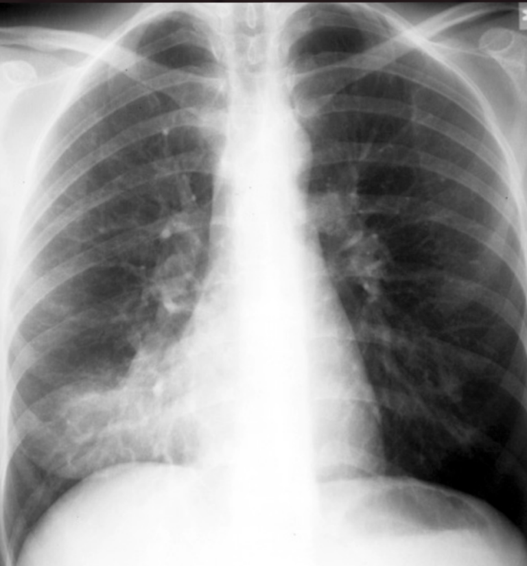 001 Pneumonia – right middle lobe | Emergency Medicine PNG