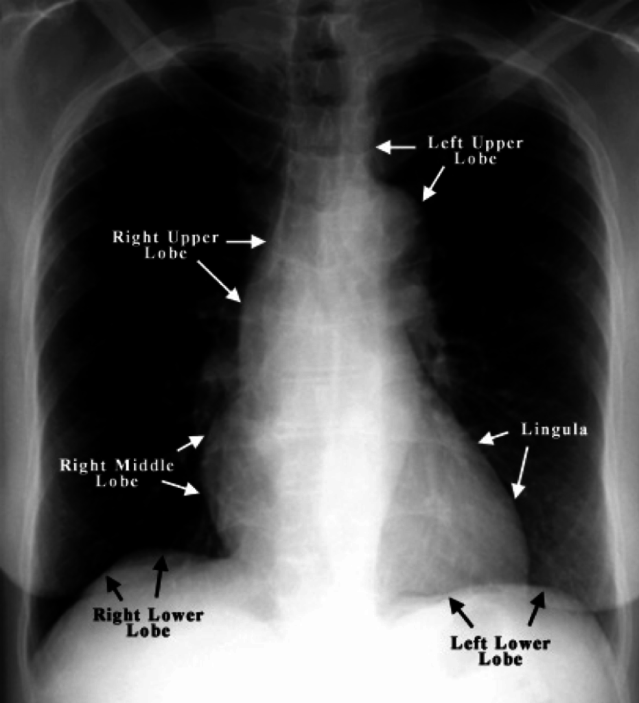 Normal CXR anatomy 2 | Emergency Medicine PNG