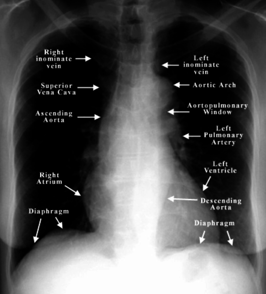 Normal CXR anatomy 3 | Emergency Medicine PNG
