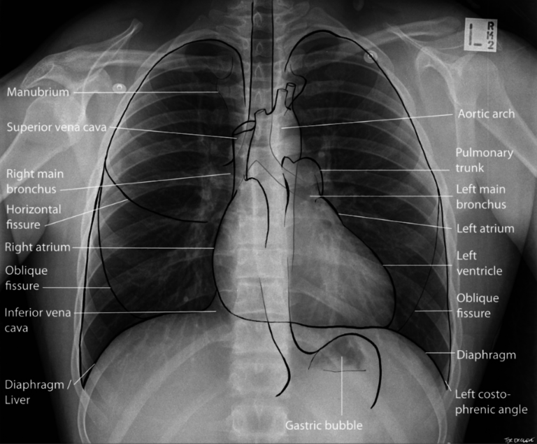 Normal CXR anatomy | Emergency Medicine PNG